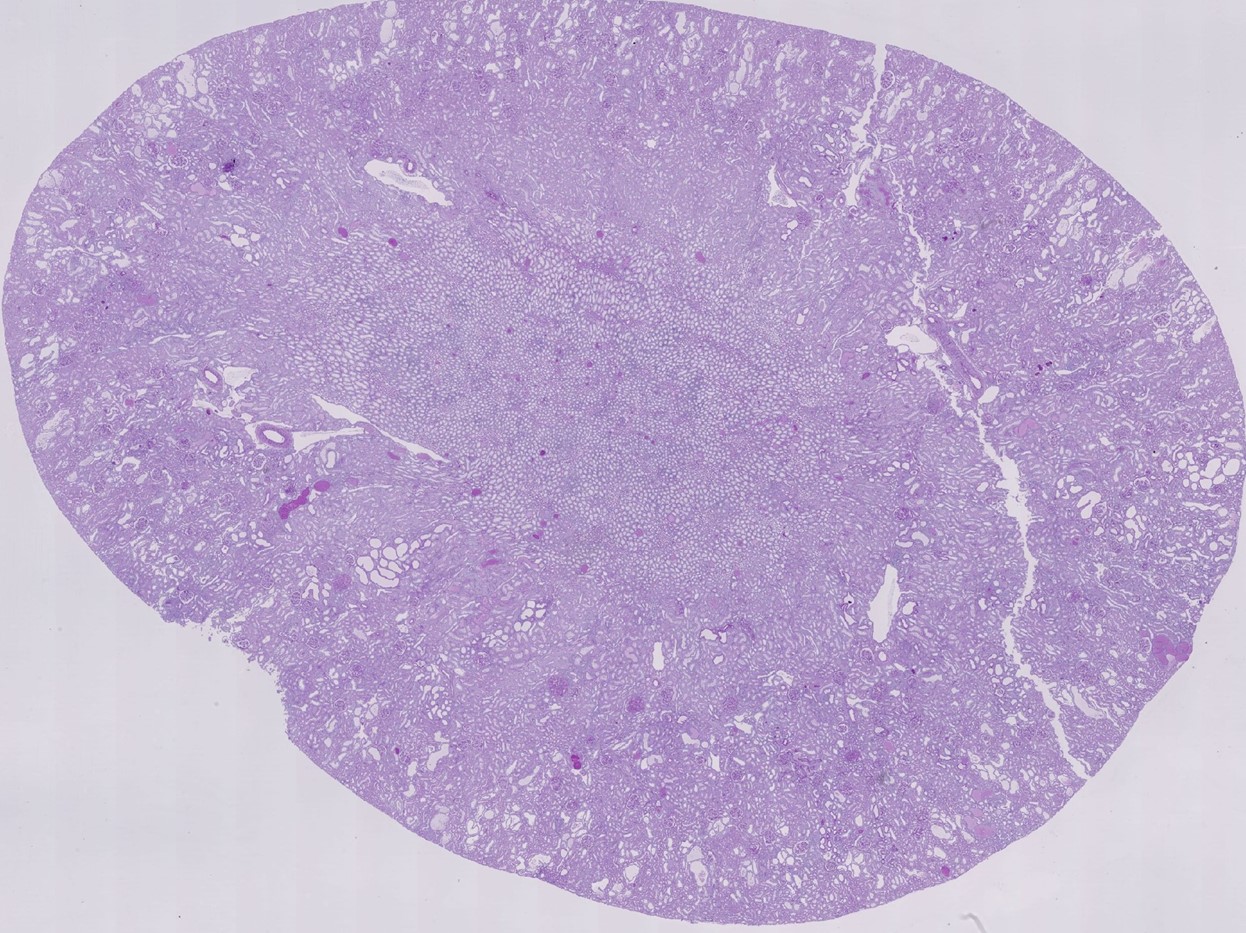 AI kidney disease models for CKD monitoring - Aiosyn